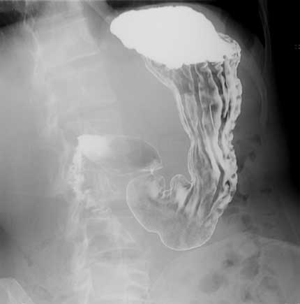 Upper GI | Esophagram | Barium Swallow